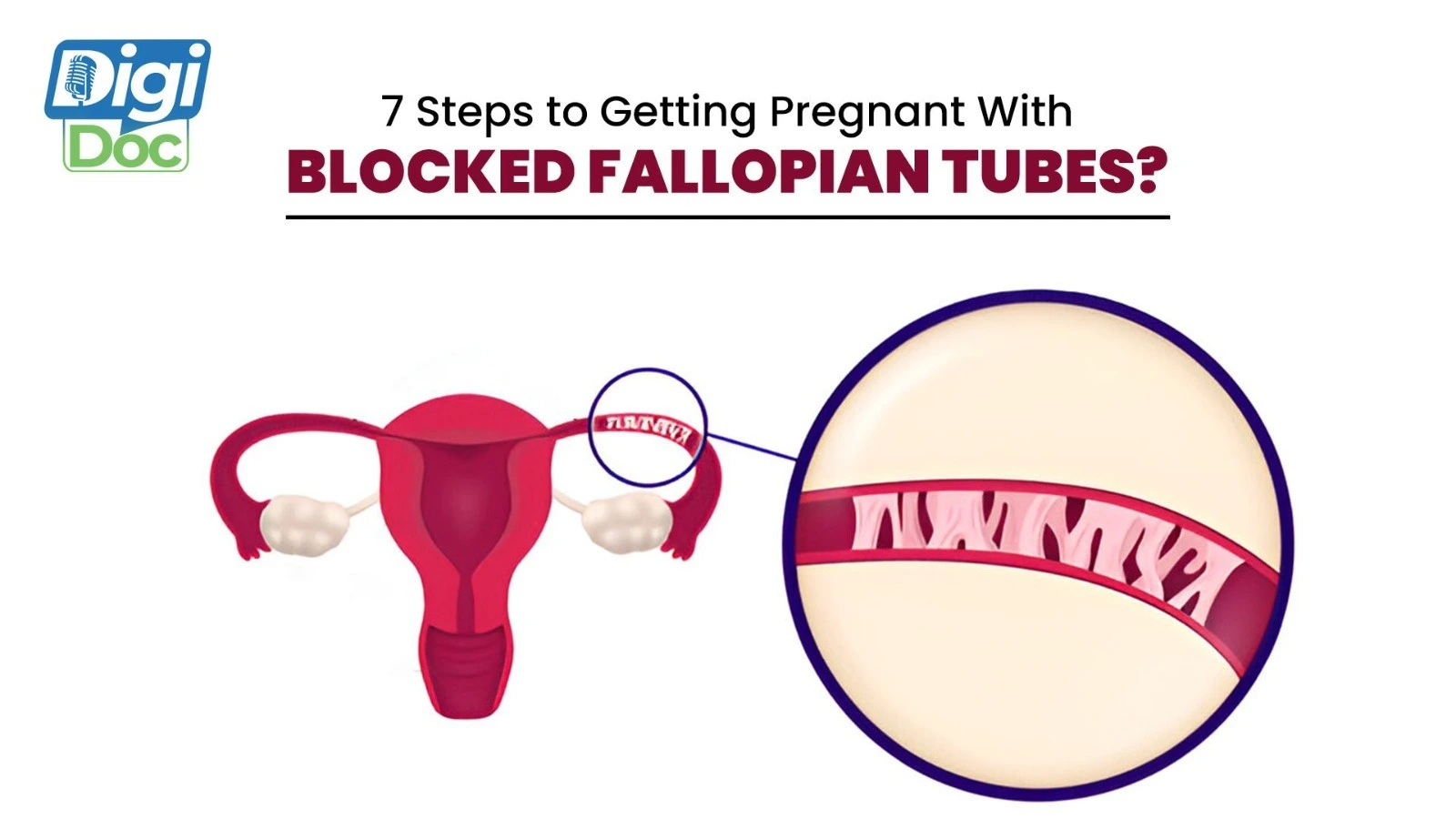 7 Steps to Getting Pregnant With Blocked Fallopian Tubes : Digi Doc TV